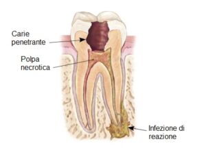 Endodontics: root canal treatment and tooth devitalization in Albania